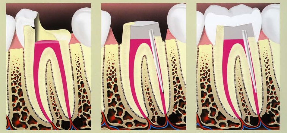 Tratamentul de canal | Chirurgie Orala