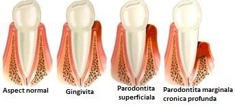 Parodontita marginală | Chirurgie Orala