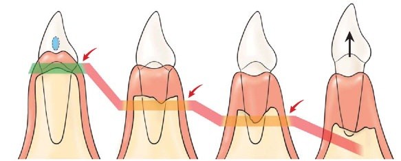 Parodontita marginală | Chirurgie Orala